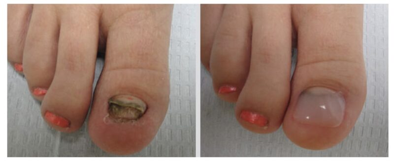 Keryflex Nail Restoration - Brighton Road Podiatry